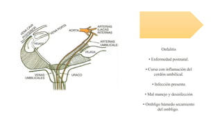 Onfalitis | PPTX