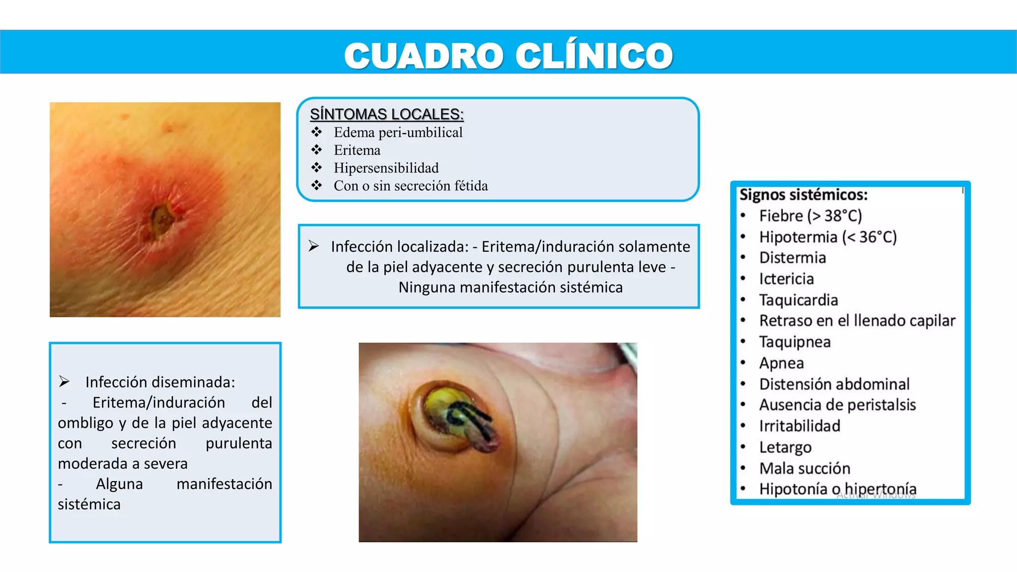 ONFALITIS - CMCM.pptx