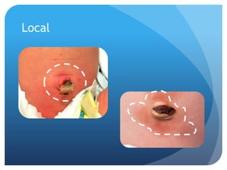 Onfalitis final diagnostico oportuno.pptx