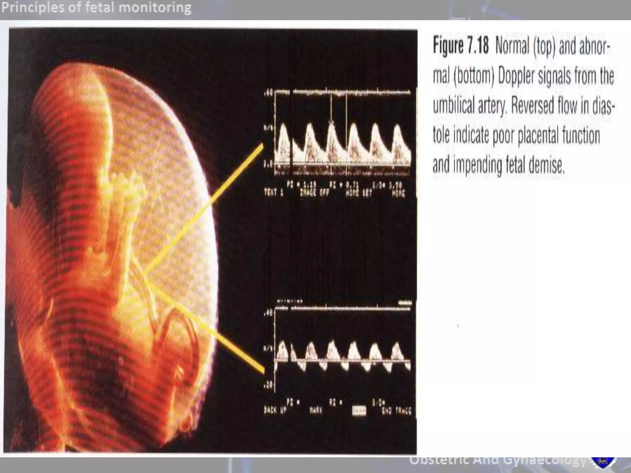 Foetal Monitoring | PPTX