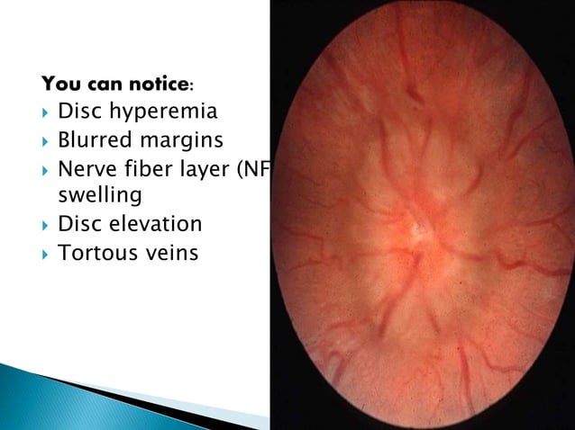 optic nerve head swelling