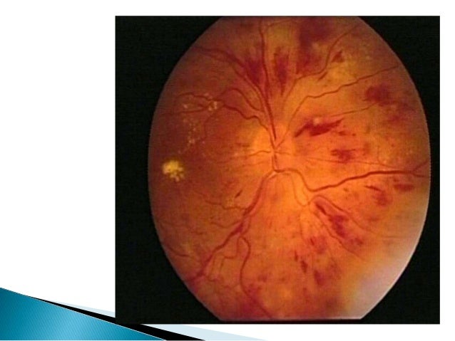 optic nerve head swelling