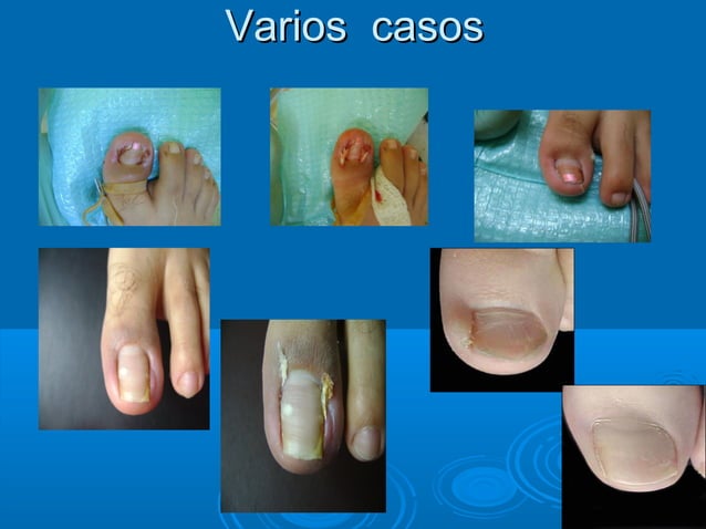 Onicocriptosis clasificacion t tratamiento | PPT