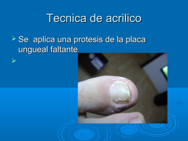 Onicocriptosis clasificacion t tratamiento | PPT