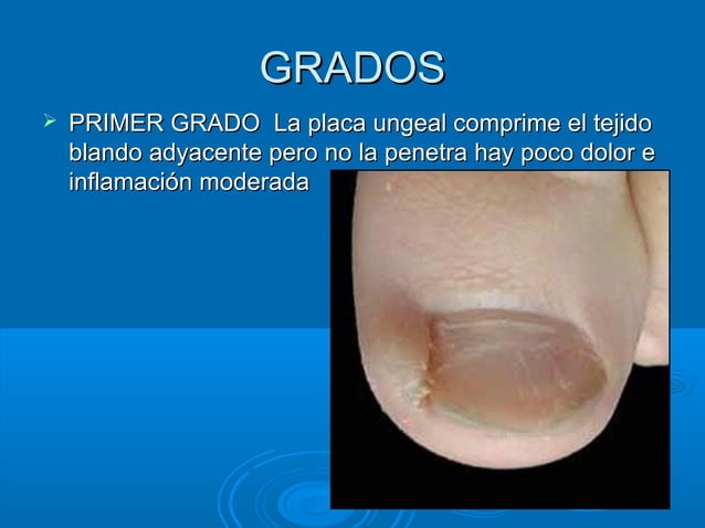 Onicocriptosis clasificacion t tratamiento | PPT