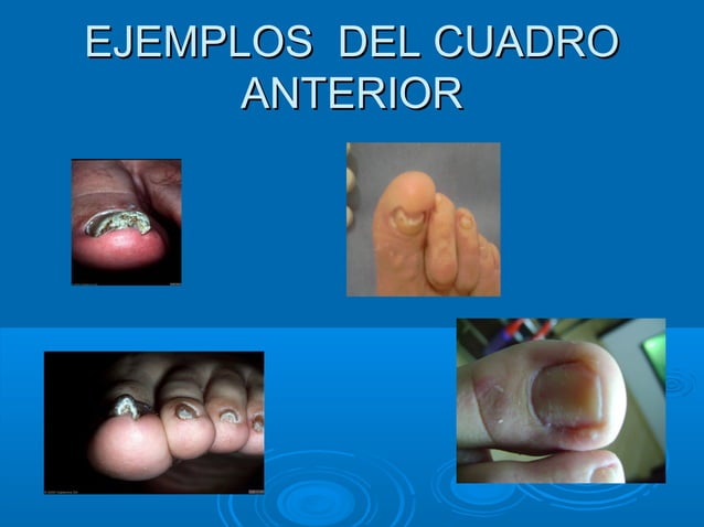 Onicocriptosis clasificacion t tratamiento
