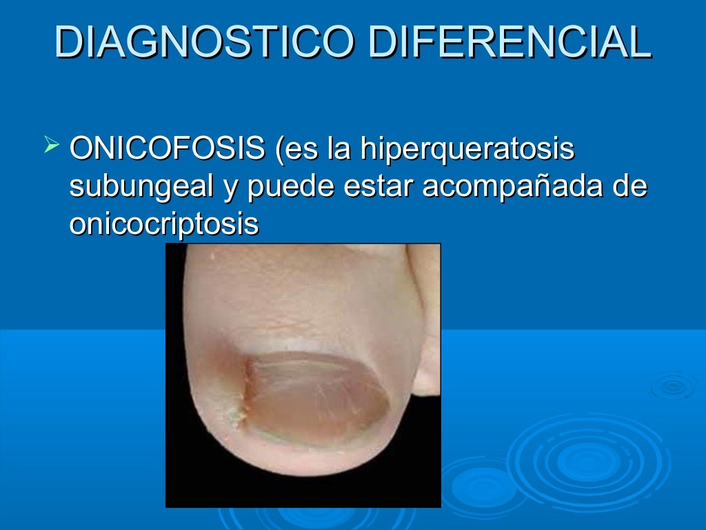 Onicocriptosis clasificacion t tratamiento