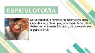 onicocriptosis o uña encarnada patología de uñas | PPTX
