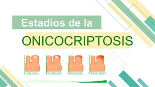 onicocriptosis o uña encarnada patología de uñas | PPTX