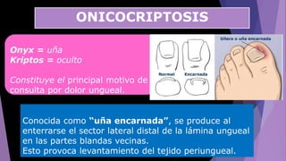 Onicocriptosis uña encarnada | PPTX