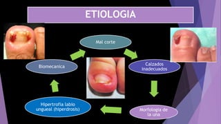 Onicocriptosis uña encarnada | PPTX