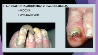 Onicocriptosis uña encarnada | PPTX