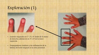 Onicomadesis | PPTX