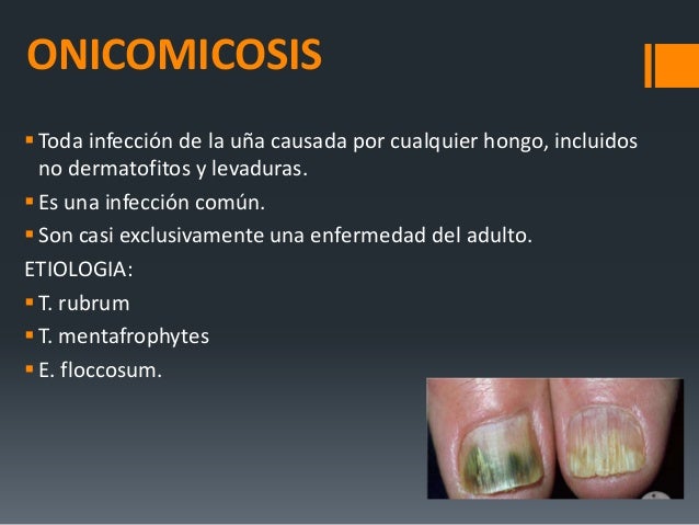 Onicomicosis-