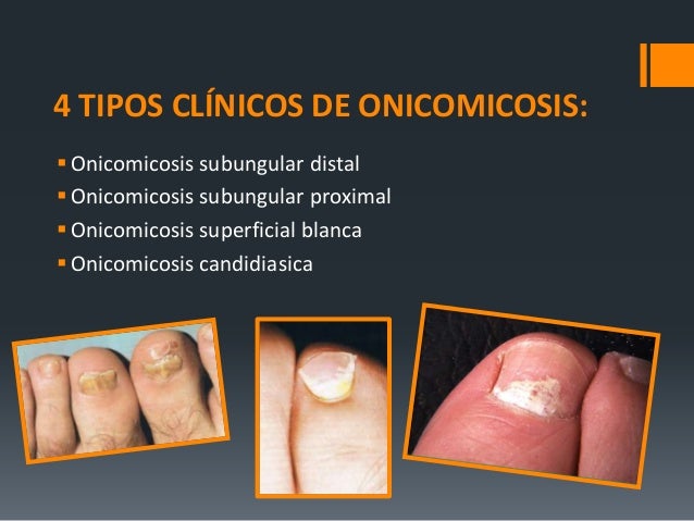 Onicomicosis-