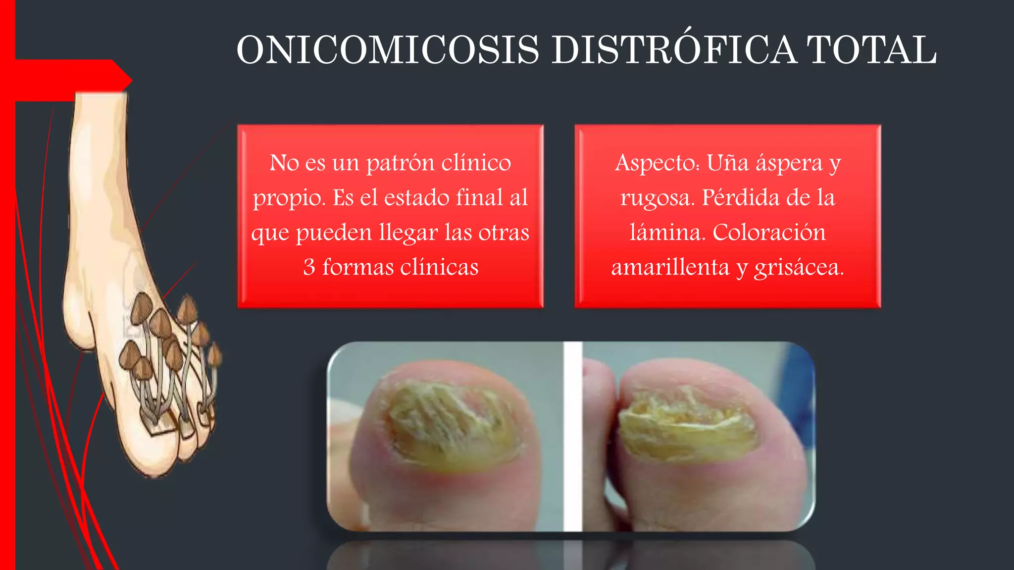Onicomicosis 140415111935-phpapp01 | PPTX