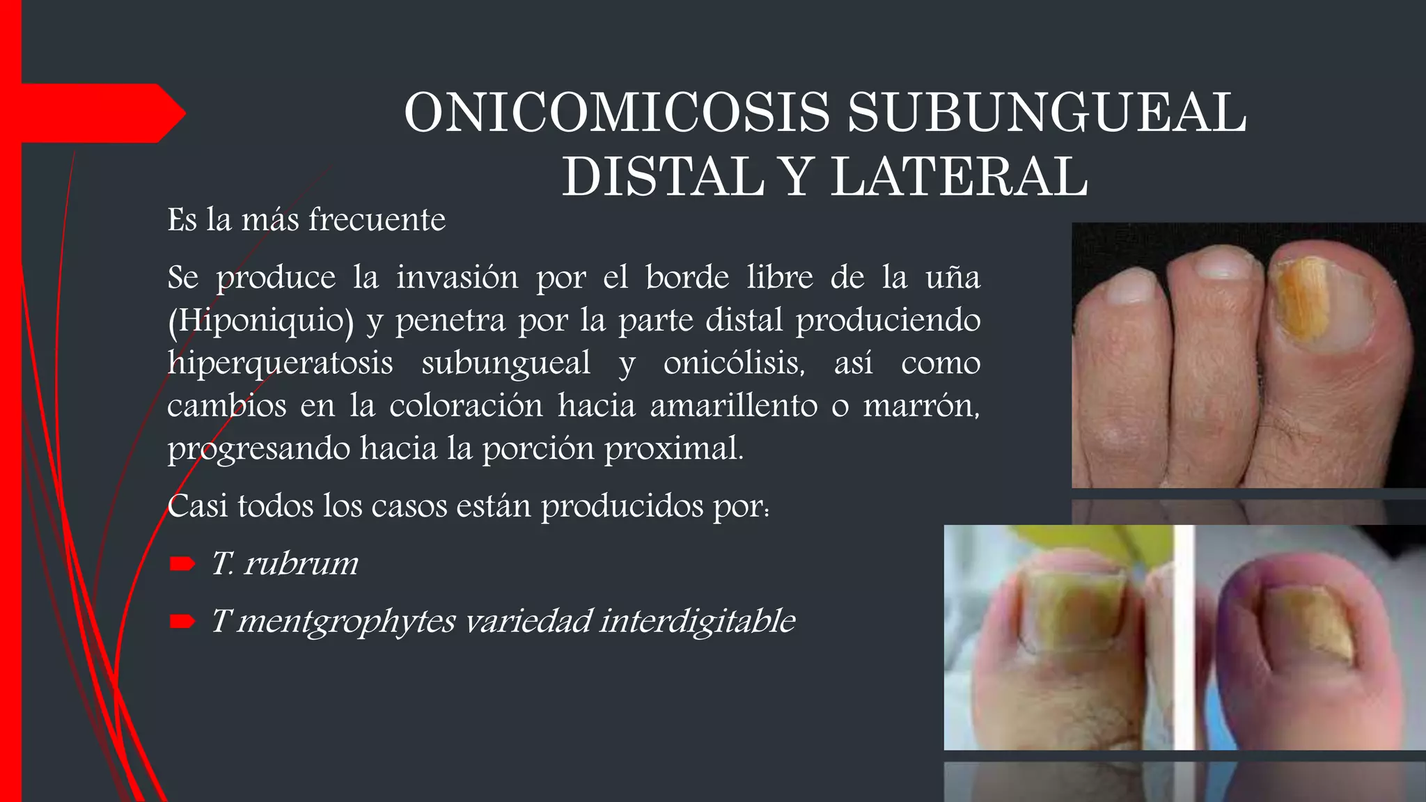 Onicomicosis 140415111935-phpapp01 | PPTX