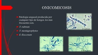 Onicomicosis 140415111935-phpapp01 | PPTX