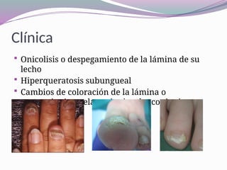 onicomicosis hongos perjudiciales salud.pptx