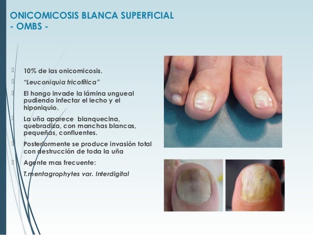 Onicomicosis, tipos, agentes infecciosos, tratamientos.