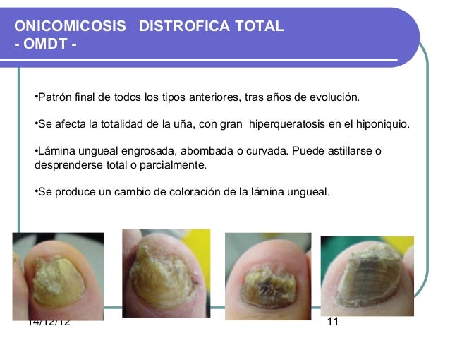 Onicomicosis