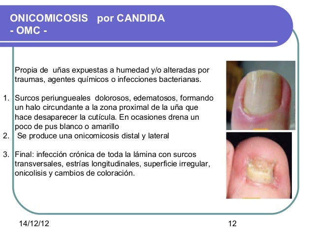 Onicomicosis
