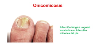 Tipos de Onicopatologias y sus definicionespptx | PPTX