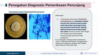 Onikomikosis otomikosis otomikosis otominosis | PPTX