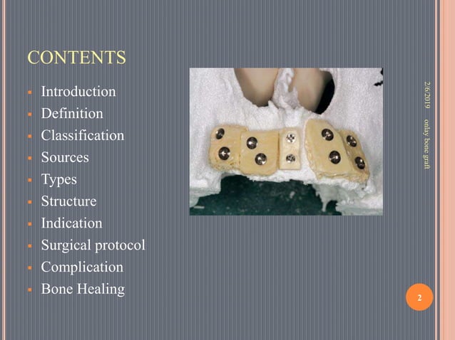 Onlay bone graft | PPTX