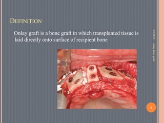 Onlay bone graft | PPTX