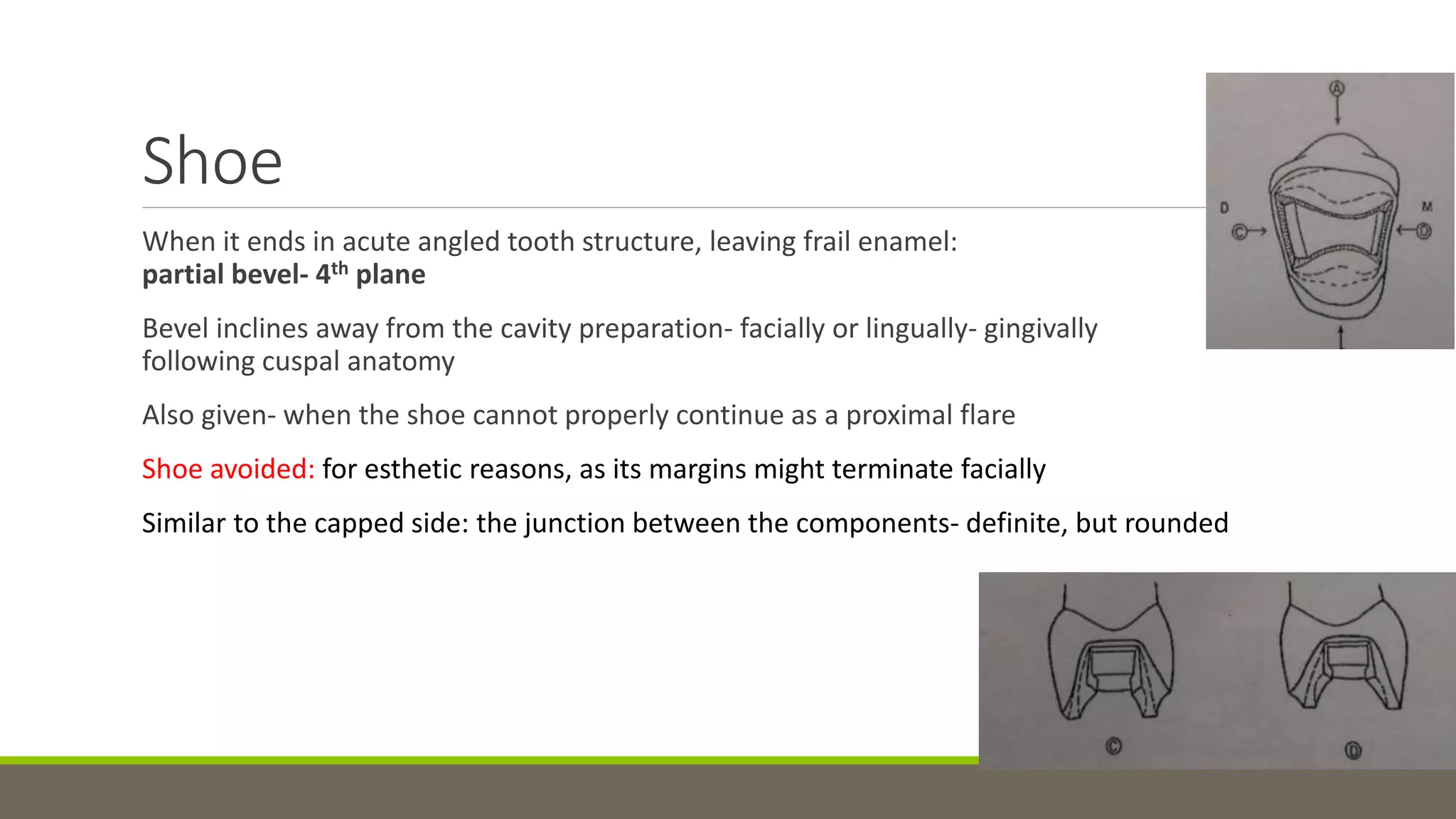 Onlay preparations | PPTX