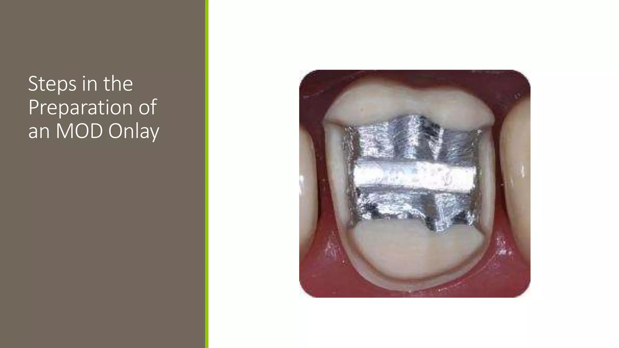 Onlay preparations | PPTX