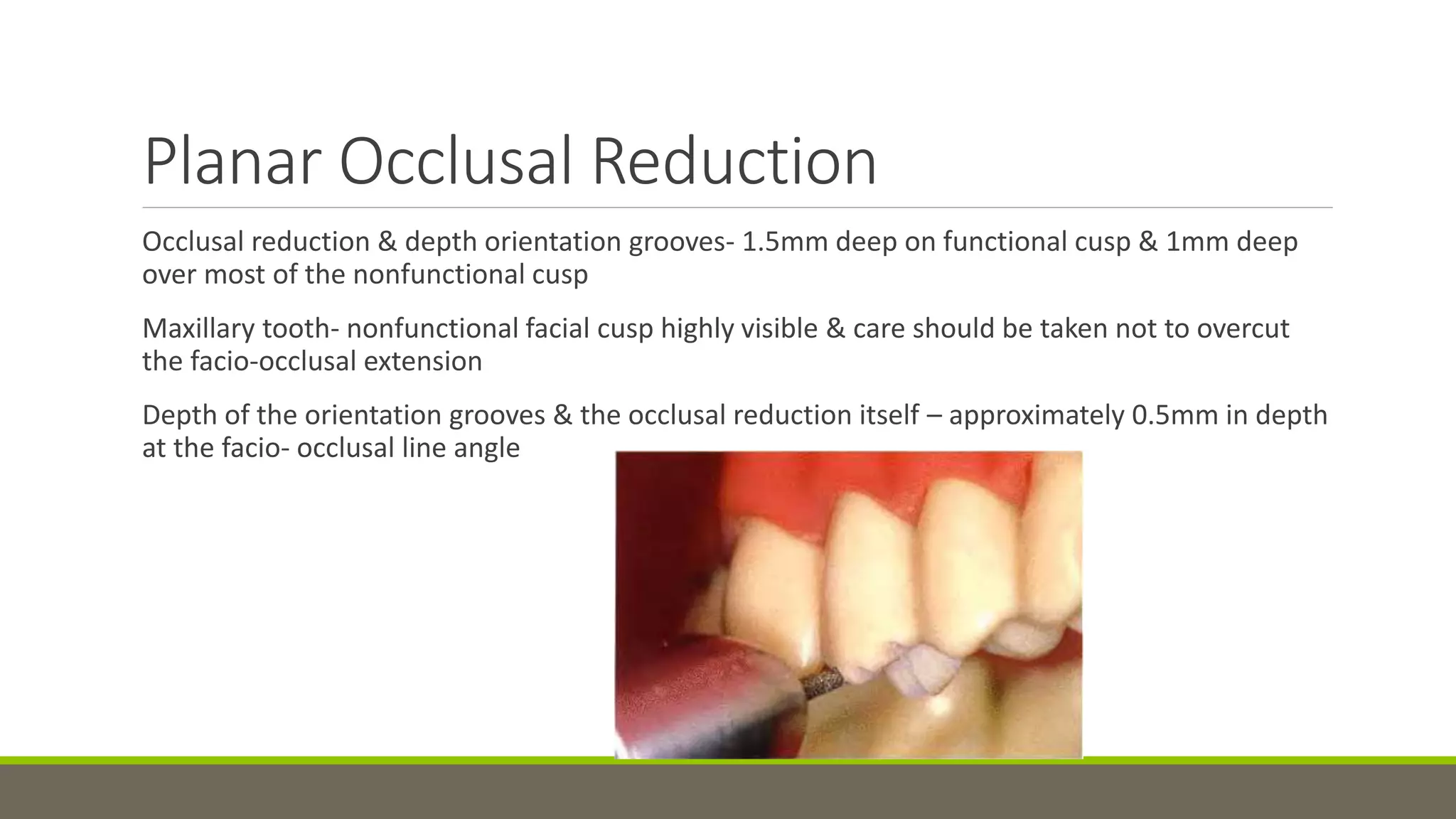 Onlay preparations | PPTX