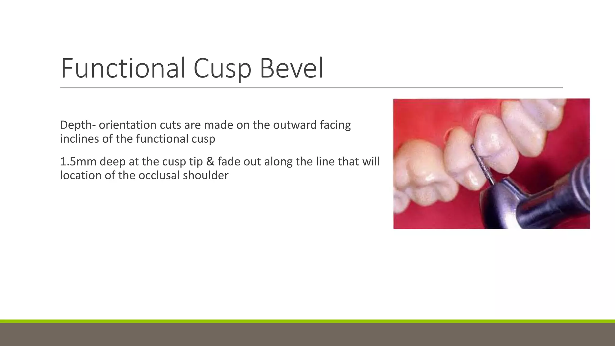 Onlay preparations | PPTX