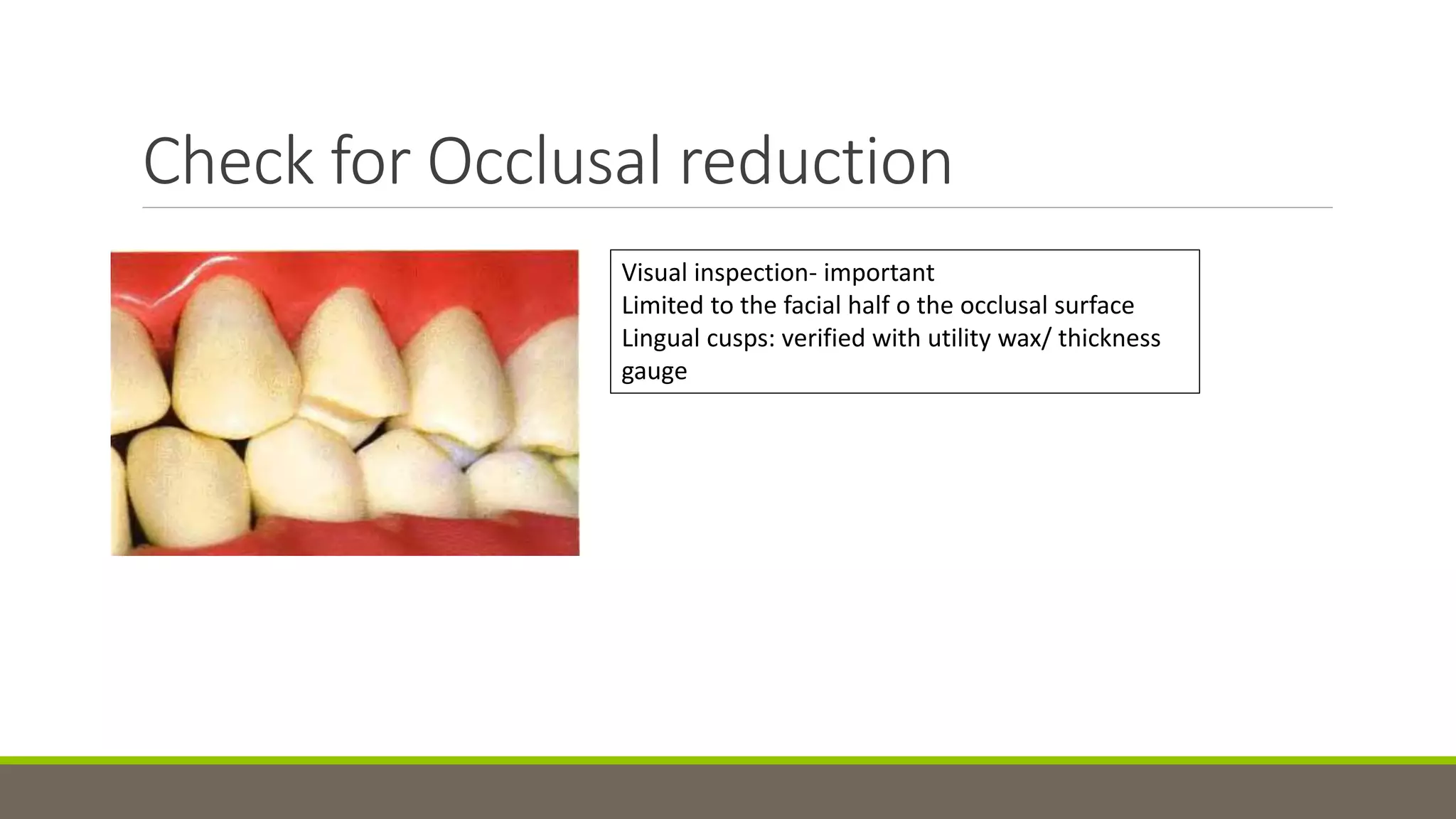 Onlay preparations | PPTX