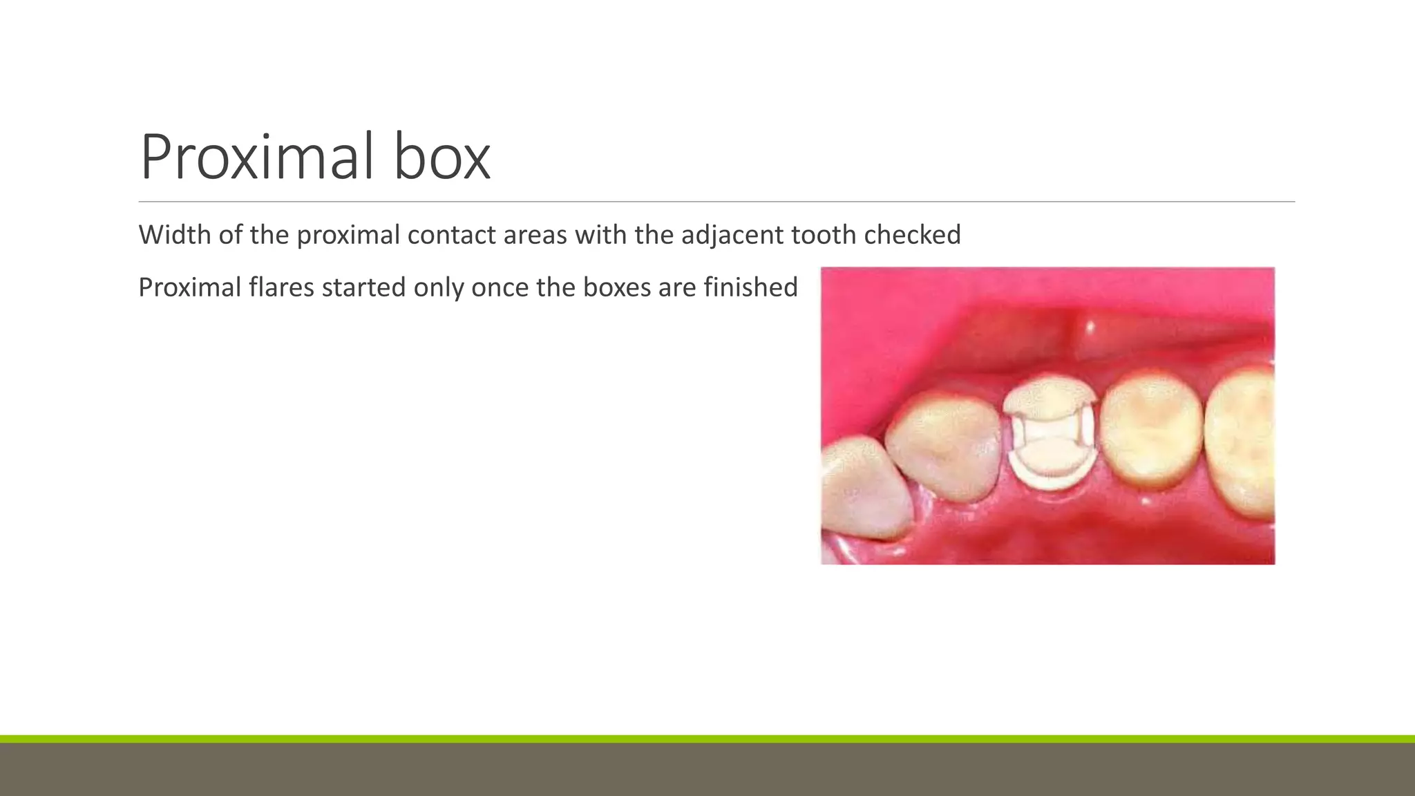 Onlay preparations | PPTX