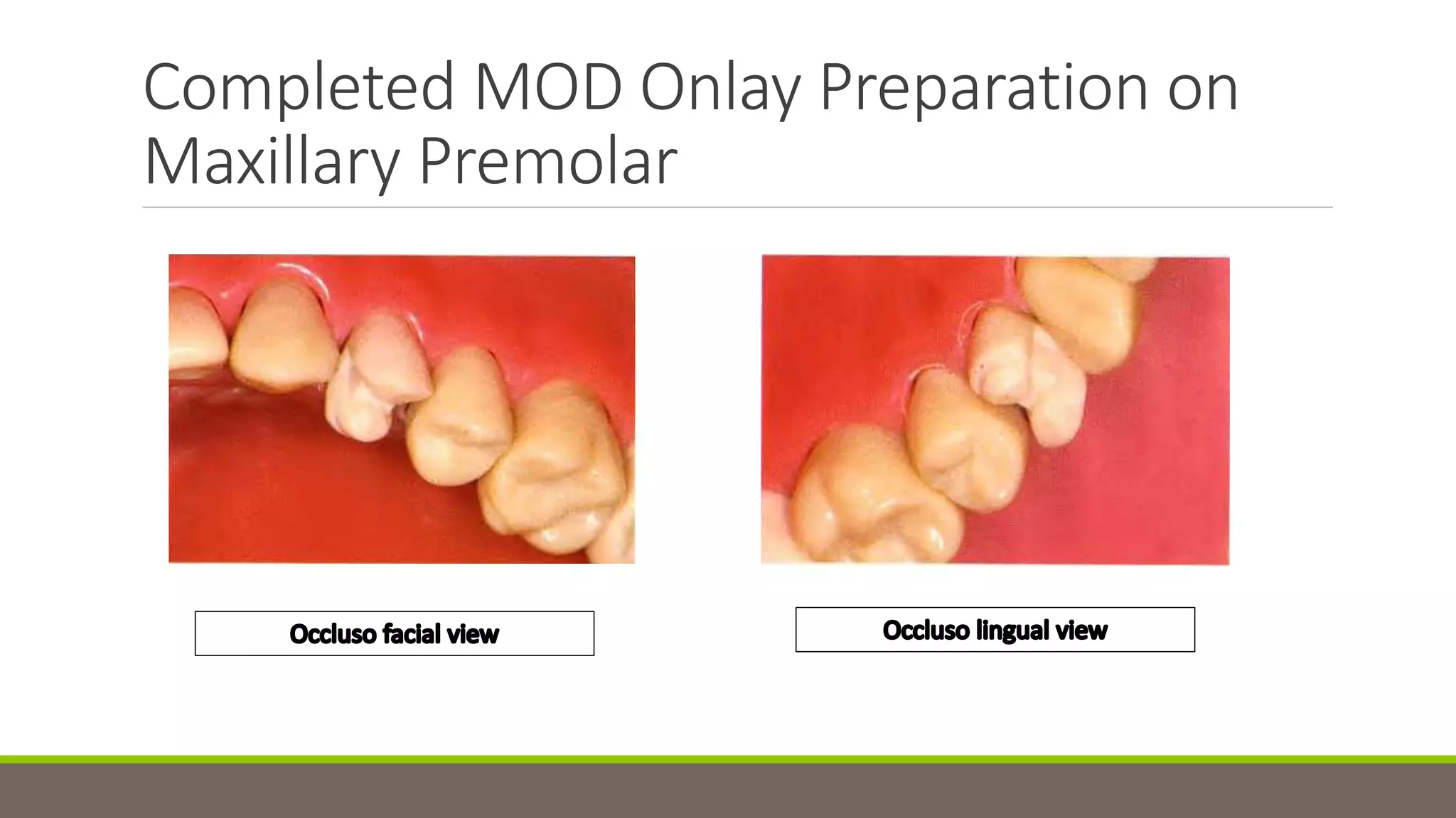 Onlay preparations | PPTX