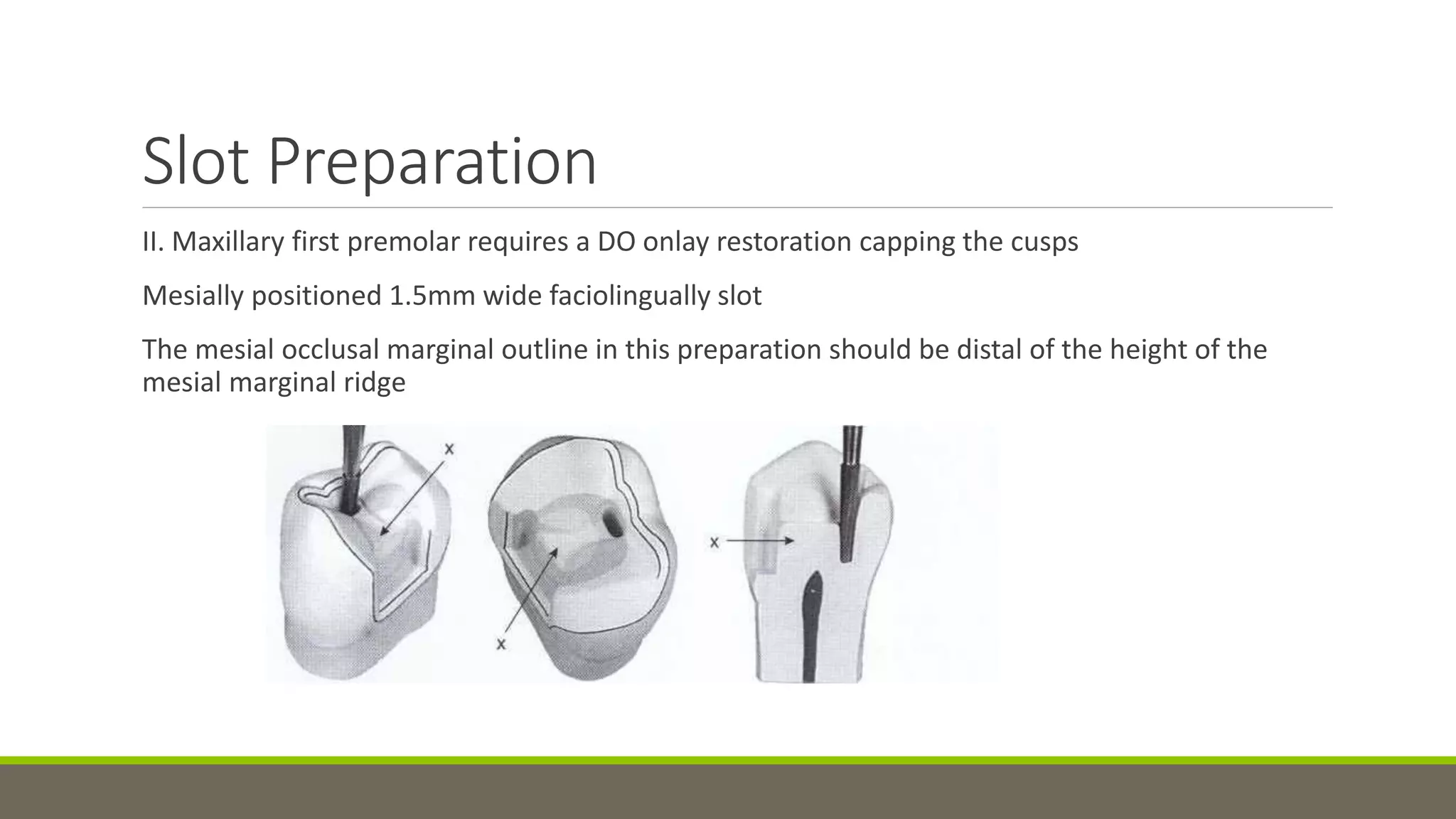 Onlay preparations | PPTX