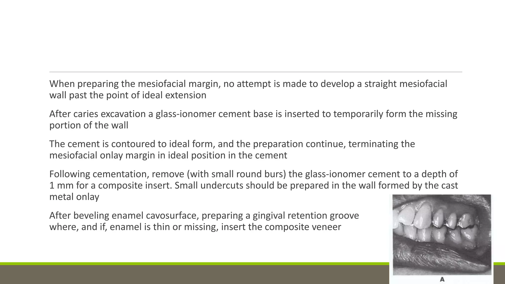 Onlay preparations | PPTX