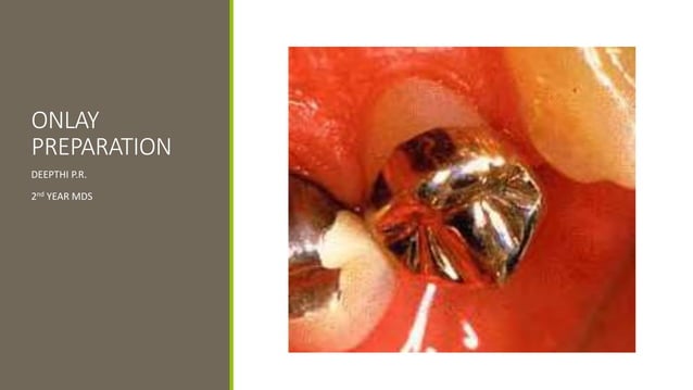 Onlay preparations | PPTX