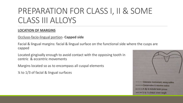 Onlay preparations | PPTX