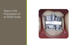 Onlay preparations | PPTX