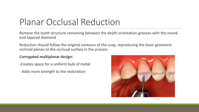 Onlay preparations | PPTX