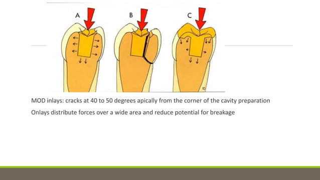 Onlay preparations | PPTX