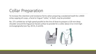 Onlay preparations | PPTX