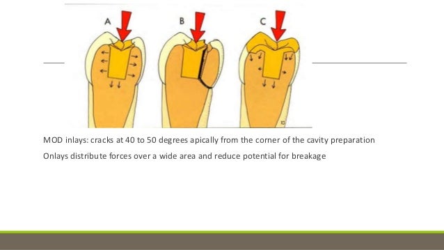 Onlay preparations