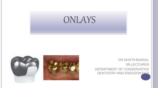 onlays edit.ppt