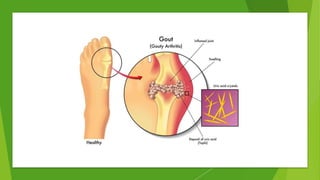 Online Class - Gout Arthritis (Done).pptx