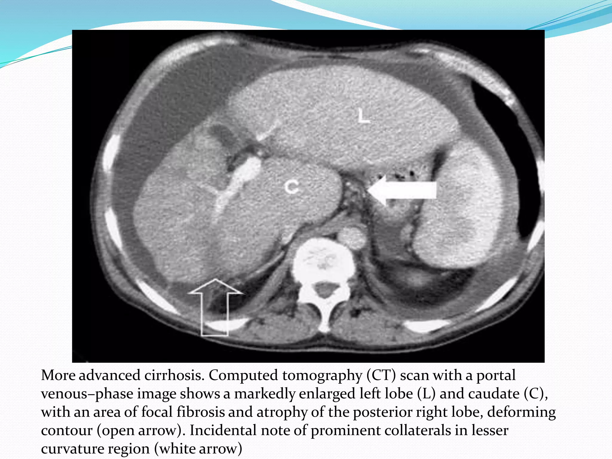 Chronic Liver Disease in pediatric: a case presentation and discussion ...