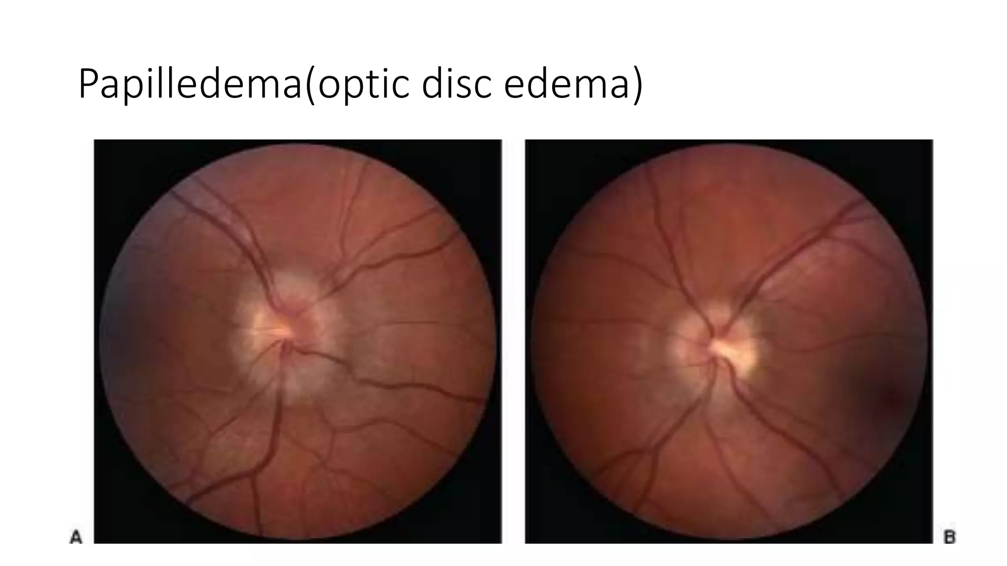 Optic Nerve and pupil tutorial | PPT